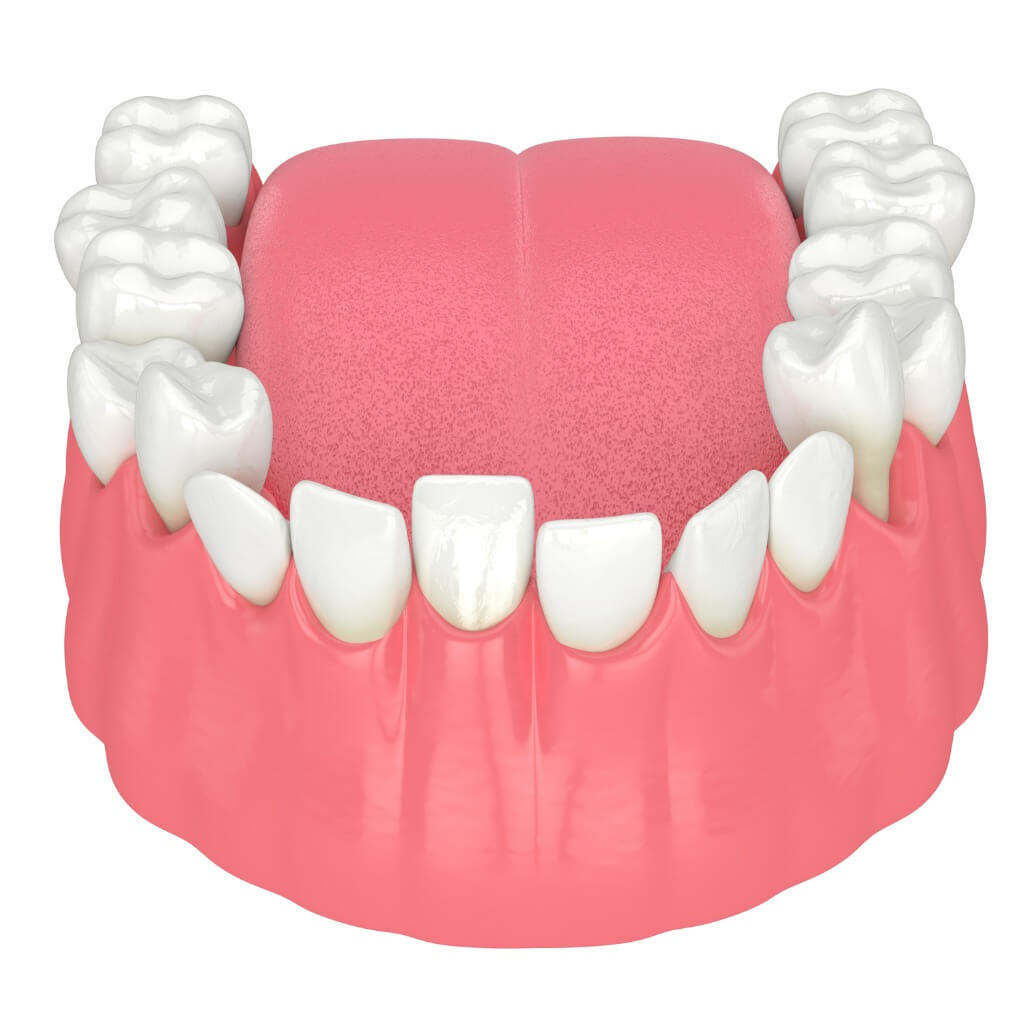 Can You Straighten Crowded Teeth at Home? - ID.me Insider